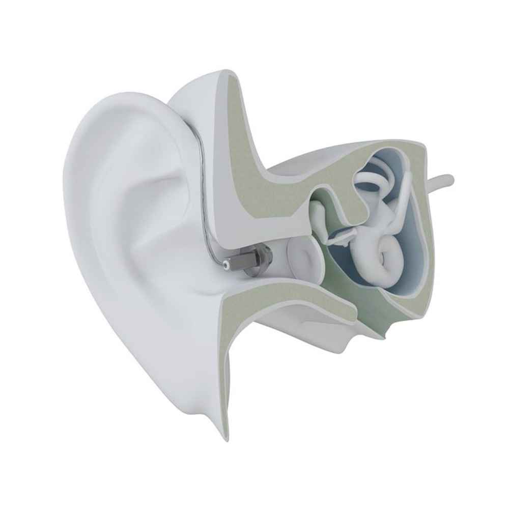 Ακουστικά βαρηκοΐας Resound με δέκτη στο αυτί (Receiver In Ear - RIE)